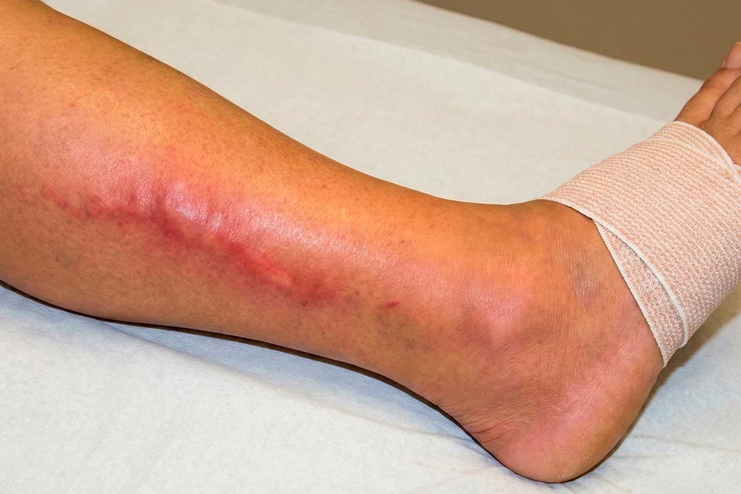 Qué es la flebitis, sus causas y tratamiento para curarla - EGP ...