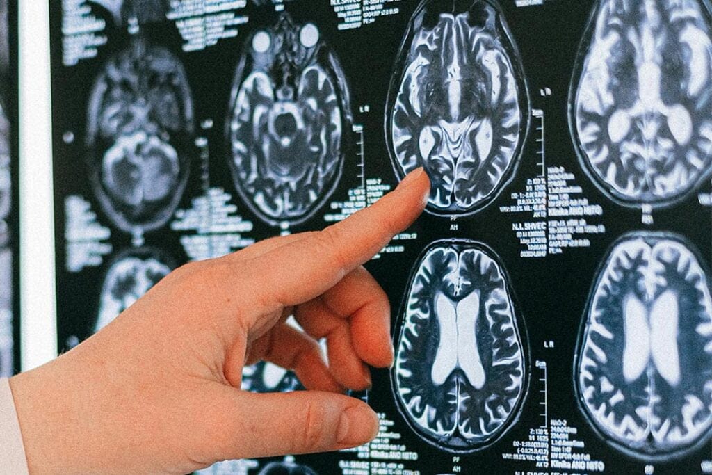 Microdiscectomía en hernia discal lumbar | Qué debes saber